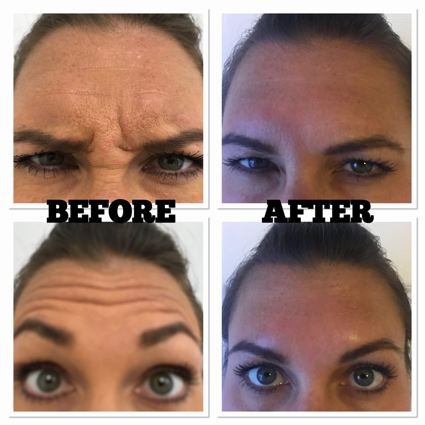 Xeomin Treatments | Sikora Medical | Vero Beach, FL